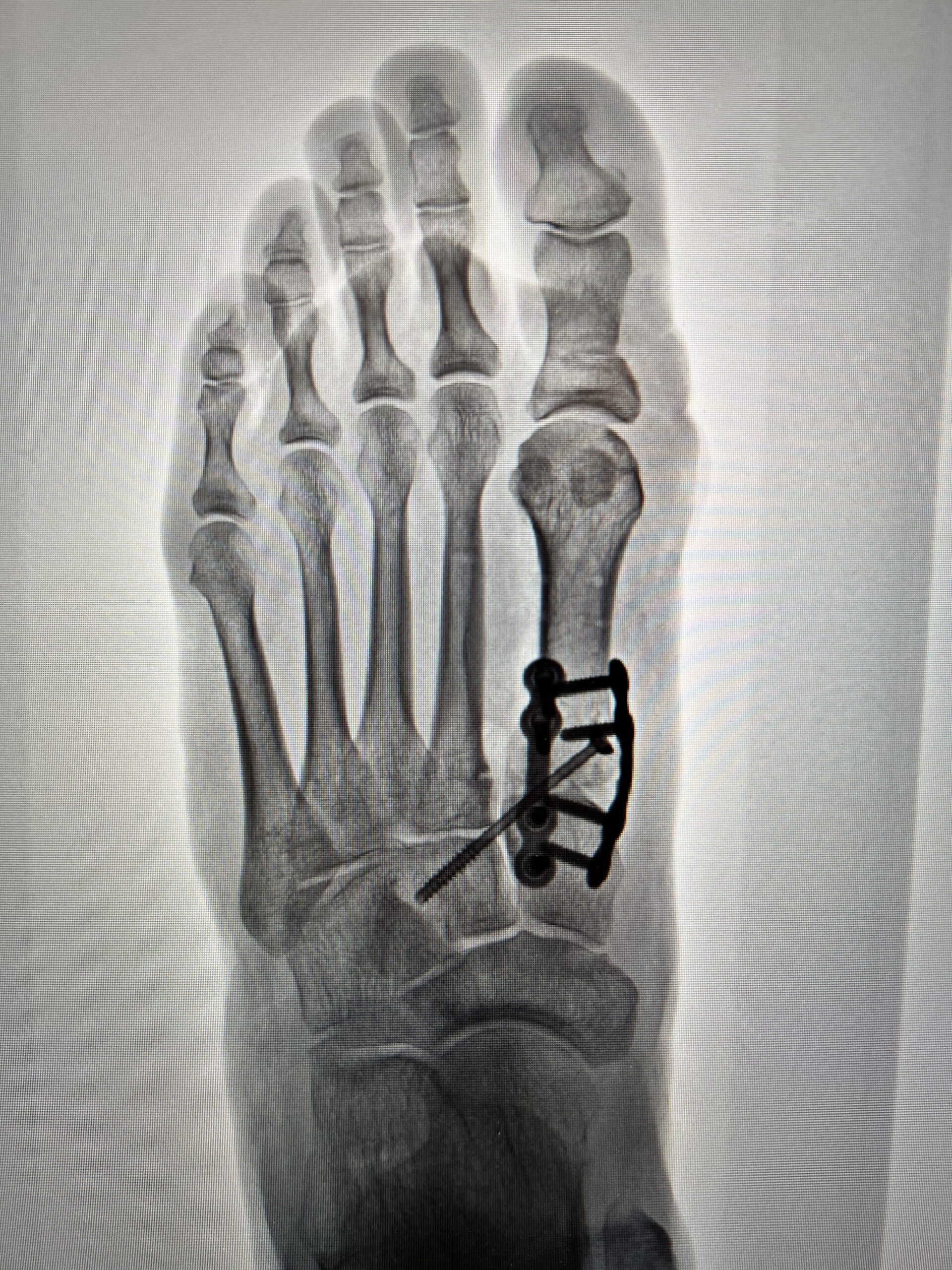 Gallery - 3D Bunion AZ