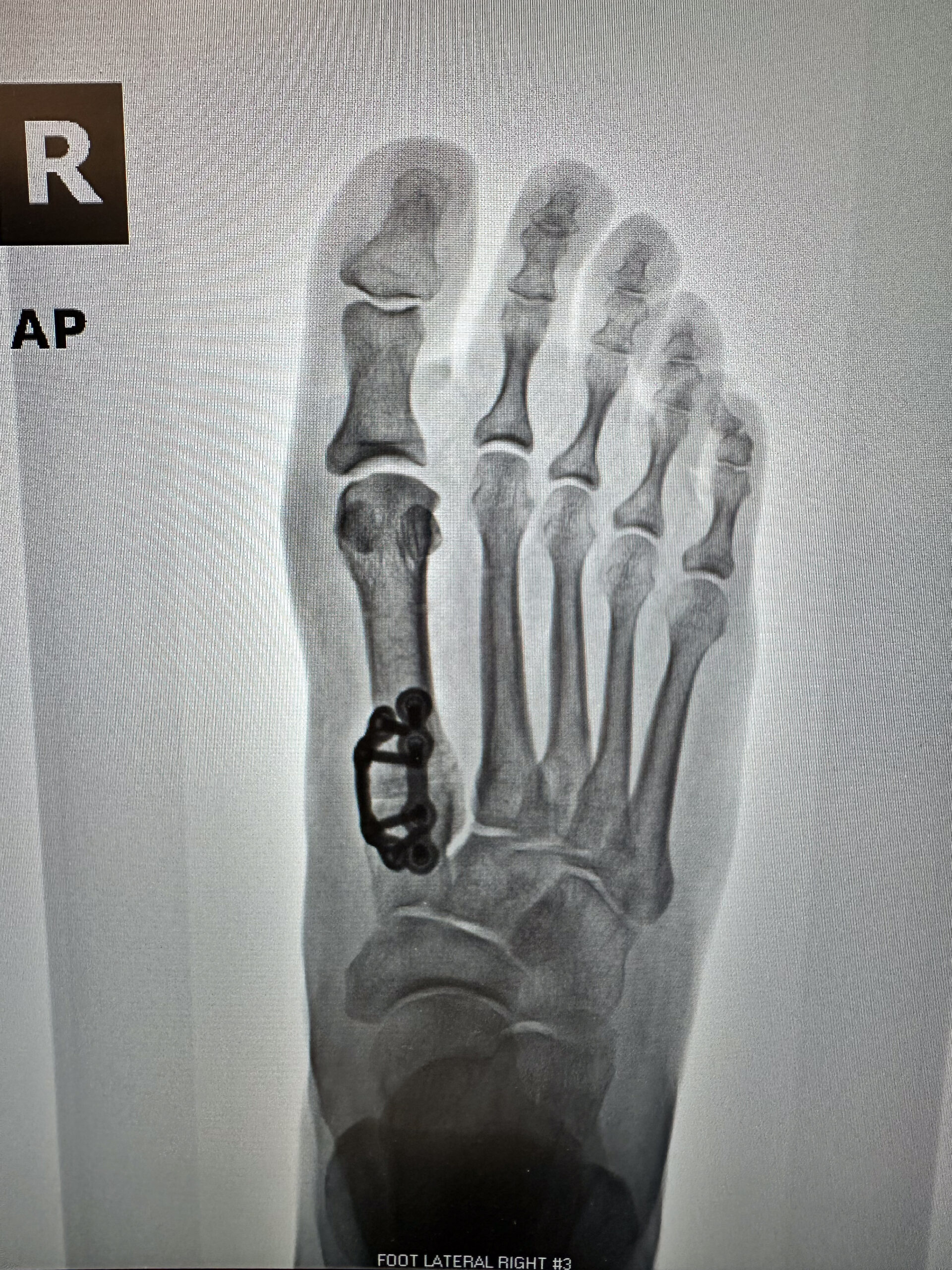 Gallery - 3D Bunion AZ
