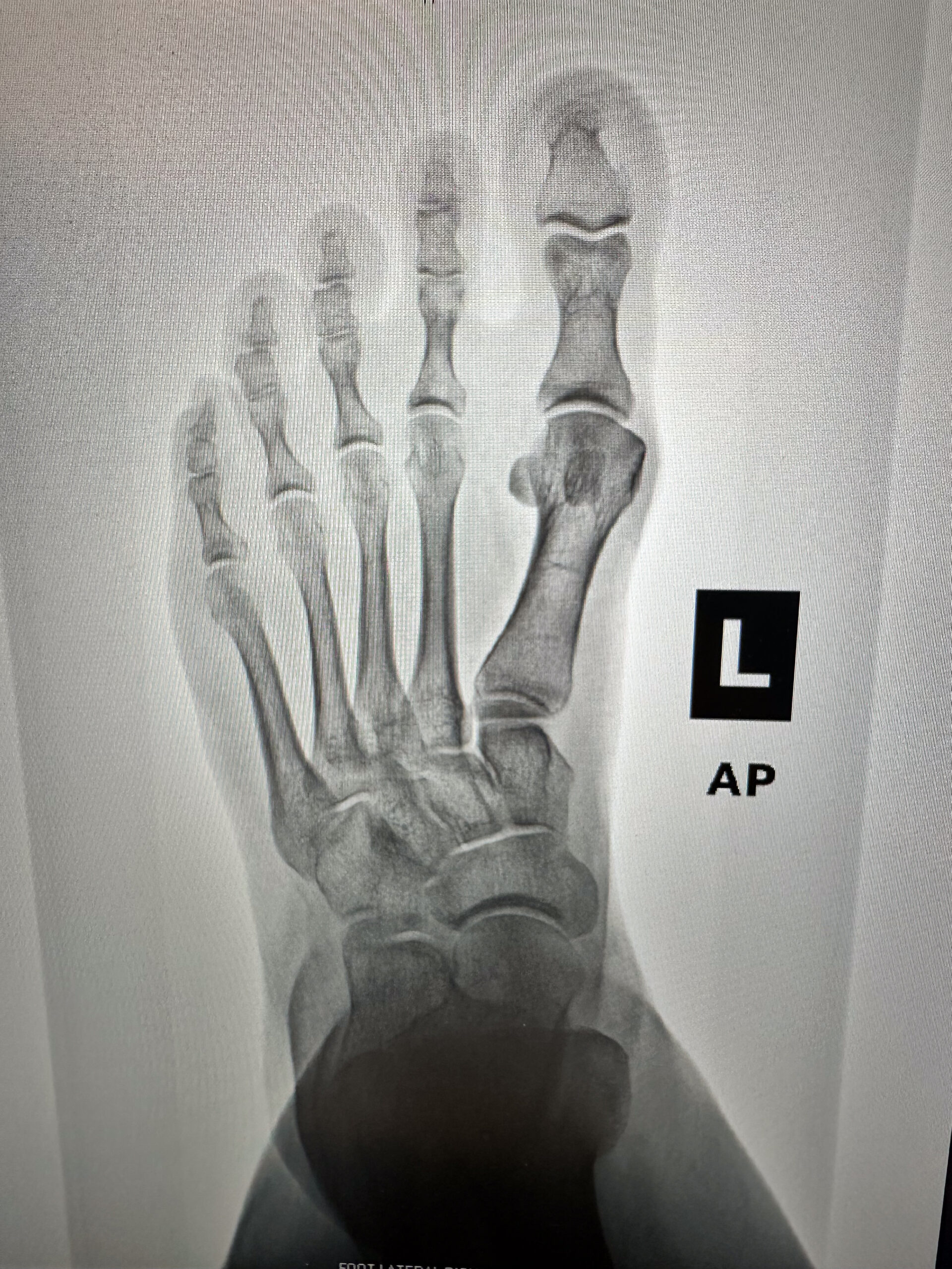 Gallery - 3D Bunion AZ