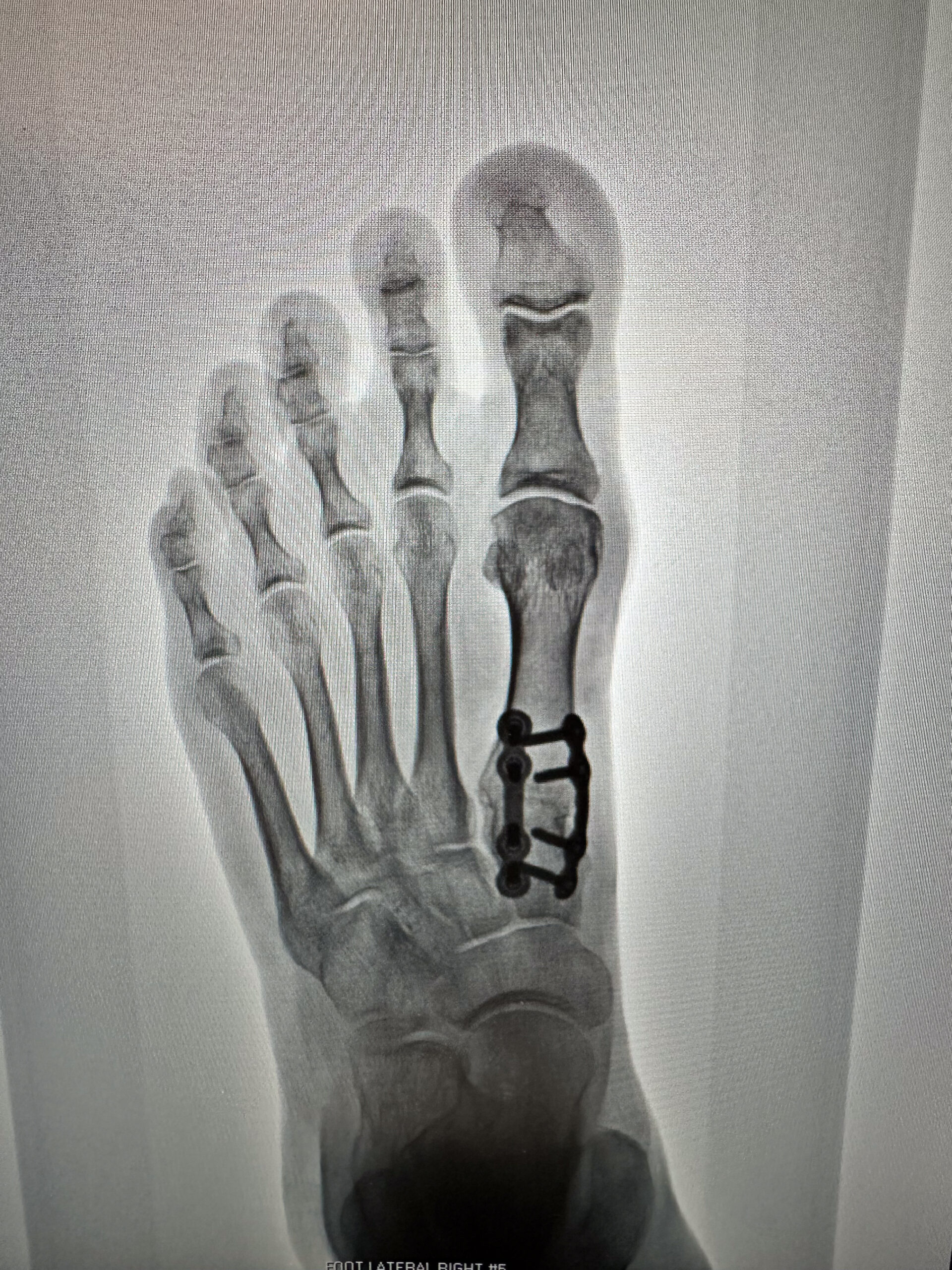 Gallery - 3D Bunion AZ