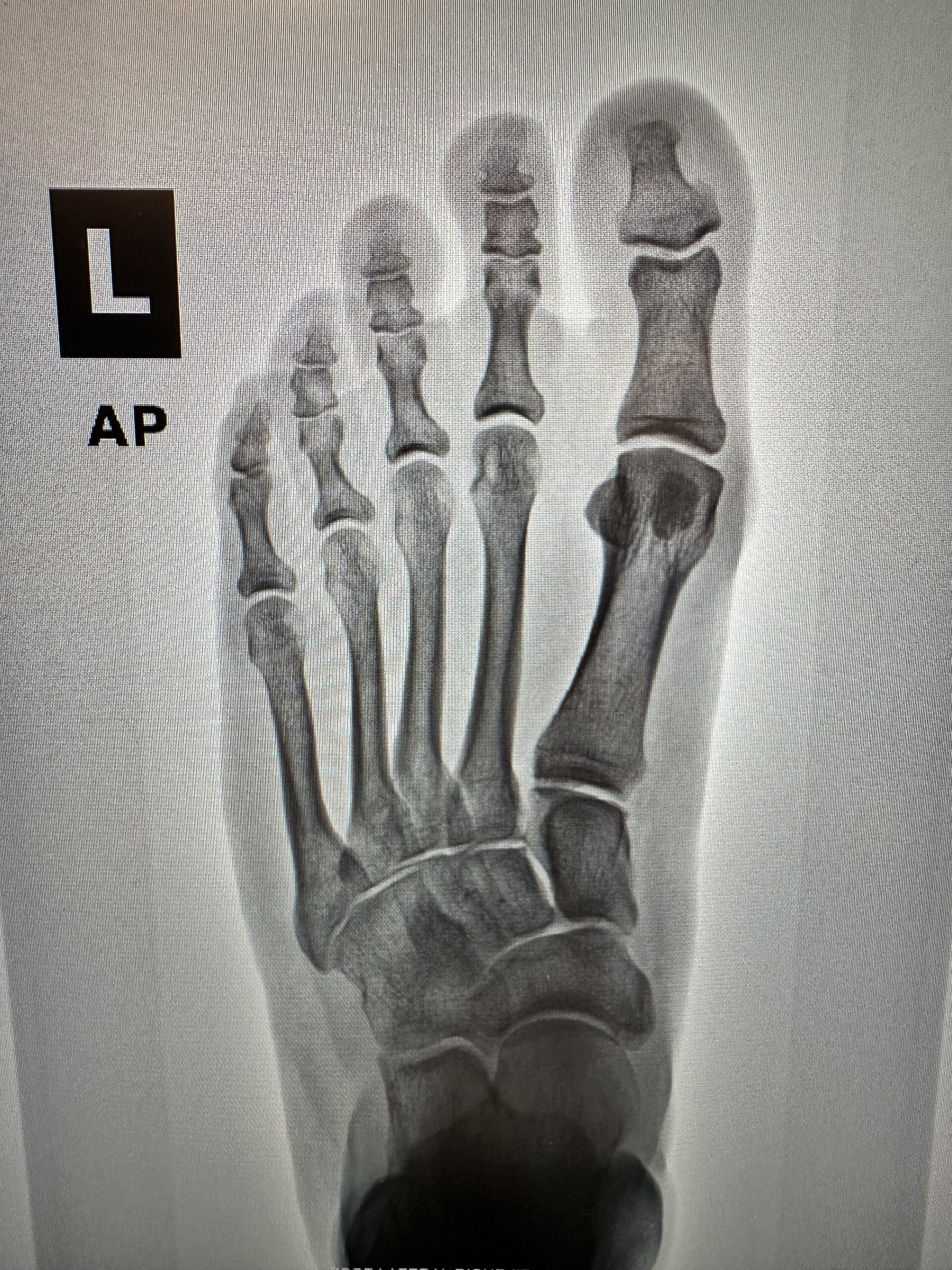 Gallery - 3D Bunion AZ