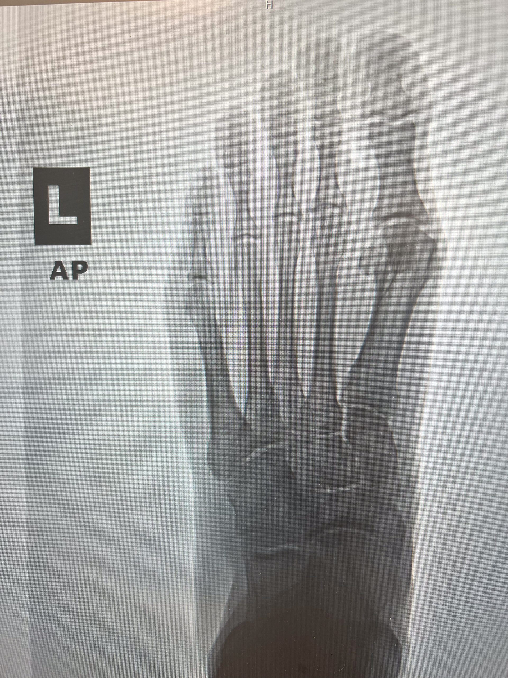 Gallery - 3D Bunion AZ