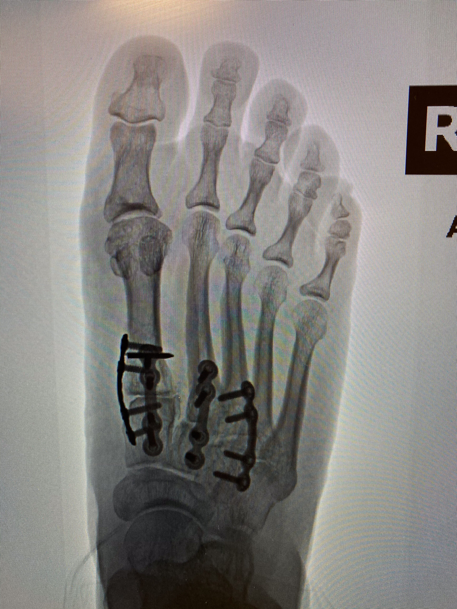 Gallery - 3D Bunion AZ
